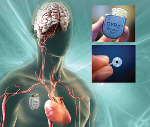 CVRx_Barostim - Cardiac Rhythm News