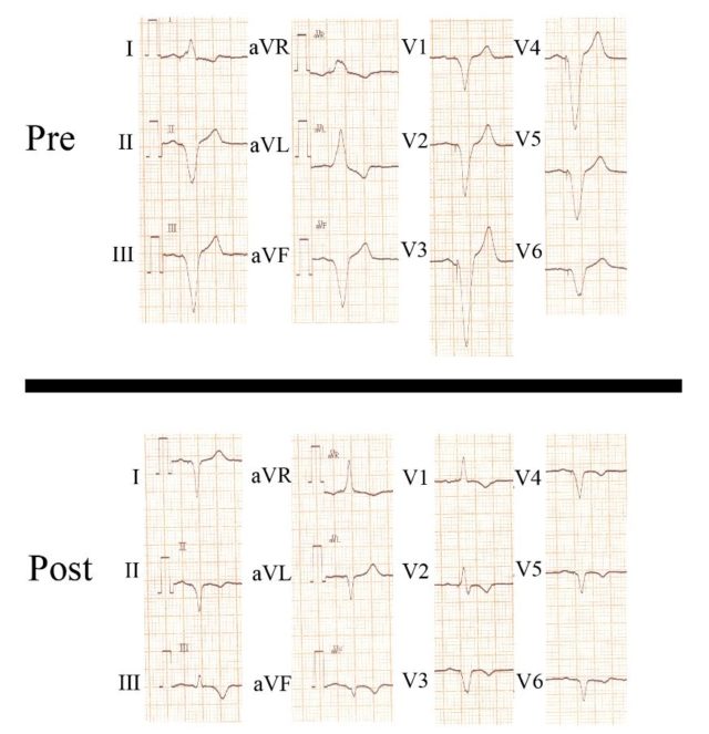 CASE REPORT: WiSE CRT technology ‒ a feasible and effective alternative ...