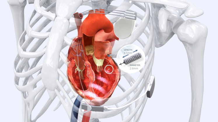 US$50 million raised for SOLVE-CRT study on wireless CRT technology ...
