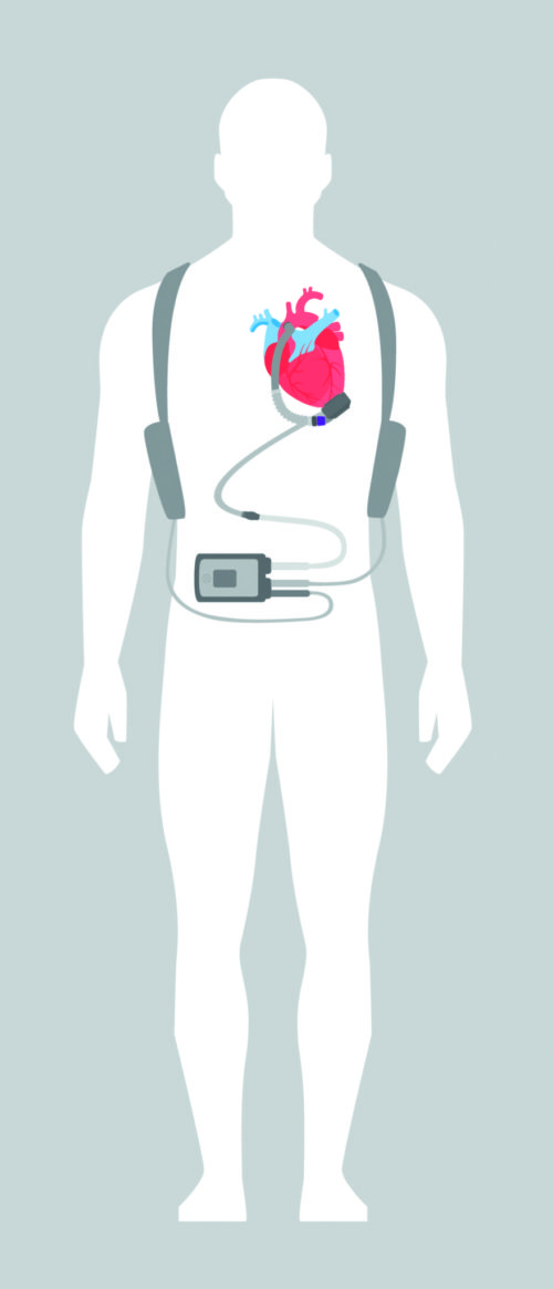 LVAD technology improves, providing better, longer-term outcomes - CRN