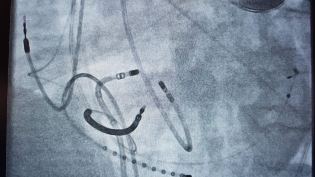 CorSystem announces first use of Bipolar Ablation Adapter - Cardiac ...