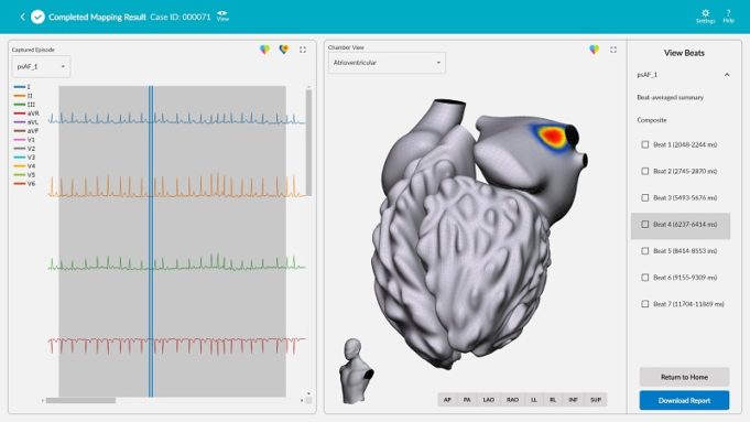 Cardiac mapping system “reduces procedural duration and fluoroscopy use”