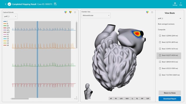 Cardiac mapping system “reduces procedural duration and fluoroscopy use”