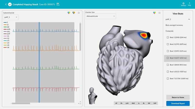 Cardiac mapping system “reduces procedural duration and fluoroscopy use”