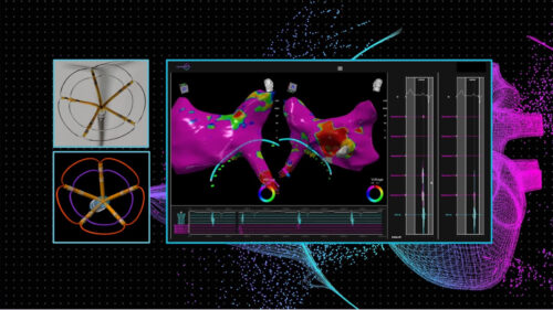 Pulse Biosciences and CardioNXT to collaborate on nsPFA first-in-human ...