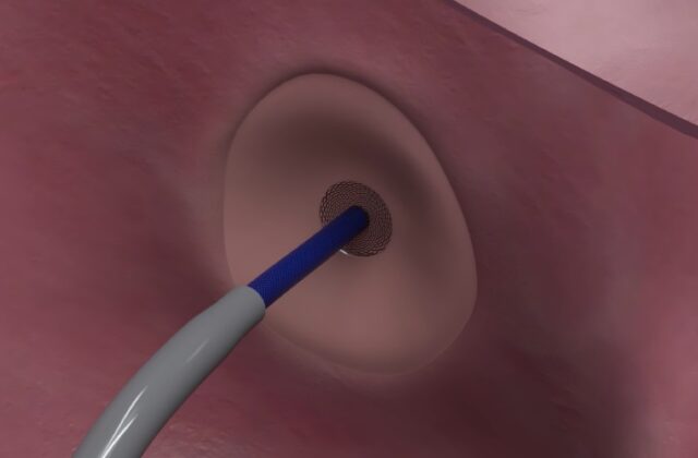 First experience of novel transseptal puncture device shared at STS ...