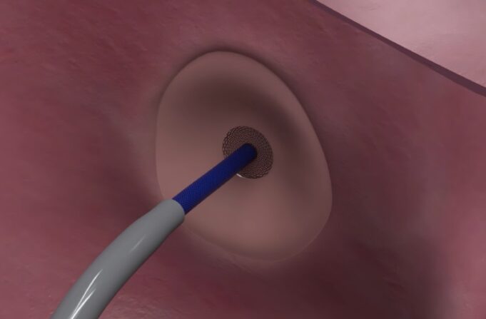 First experience of novel transseptal puncture device shared at STS ...