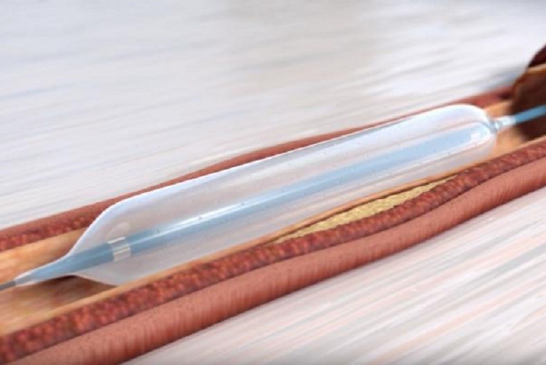 Orchestra BioMed secures additional capital from funding partners ...